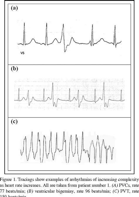 Polymorphic Ventricular Tachycardia Vs Ventricular Fibrillation