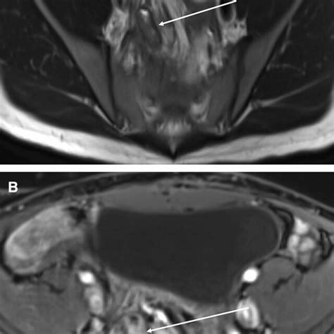 Patient Underwent Pouch Redo And Presents For Pre Loop Closure Mri A