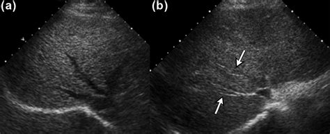 Compressed Hepatic Veins A Transverse View Of The Normal Confluence Download Scientific