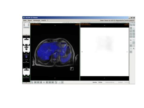 Is Asymptomatic Cholangitis No Clinical Signs Normal Bood Tests A Common Feature Of A Whipple