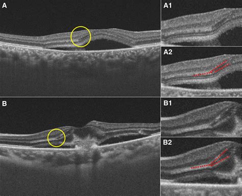 ‘y Split Of The Outer Plexiform Layer An Optical Coherence Tomography Illusion Bmj Case Reports
