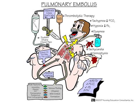 Diagnosis Pulmonary Embolism Nursing Diagnosis