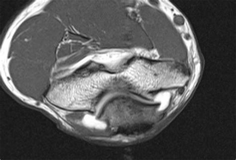 How To Read A Hip Mri Arthrogram Wilder Ateres
