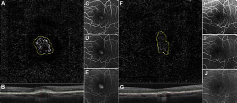 Spectral Domain Optical Coherence Tomography Angiography Of Choroidal