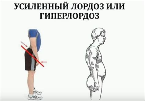 Мы расскажем о: Как исправить гиперлордоз поясницы упражнения на нашем ...