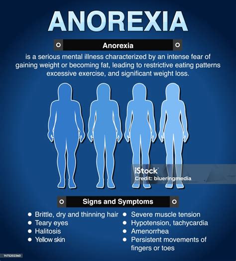 Informative Poster Of Anorexia Eating Disorder Stock Illustration