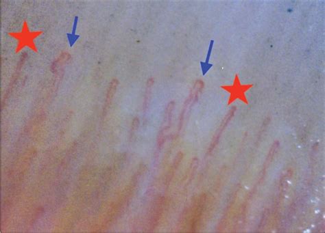Nail Fold Capillaroscopy For The Dermatologists Indian Journal Of