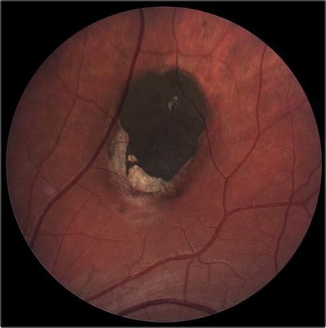 Congenital Hypertrophy Of The Retinal Pigment Epithelium Eyewiki