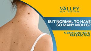 Understanding Moles Dermatologist S Guide To Skin Health