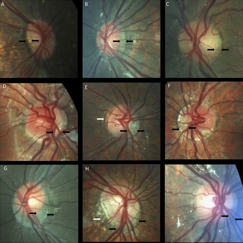 Choroidal Crescent Optic Nerve