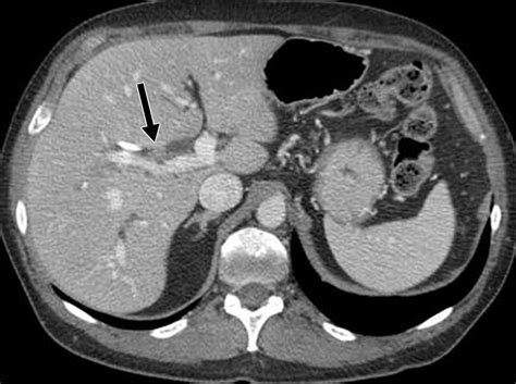 Surgical Resection Of A Malignant Liver Lesion What The Surgeon Wants The Radiologist To Know Ajr Surgical Resection Of A Malignant Liver Lesion What The Surgeon Wants The Radiologist To Know Ajr