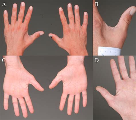 Adductor Pollicis Atrophy
