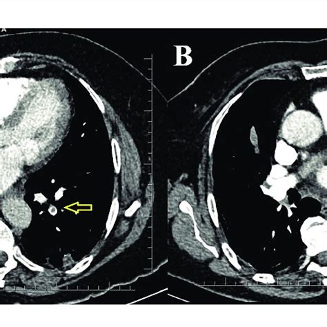 Pulmonary Artery Ct Angiography A Filling Defects In Segmental