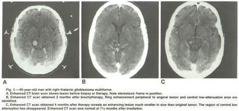 Figure 1 From Early Ct Findings After Interstitial Radiation Therapy