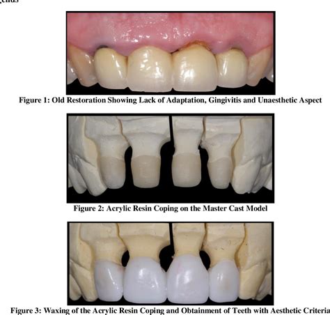 Figure 1 From A Final Esthetic Validation Technic In Fixed Prosthodontics For Special Needs