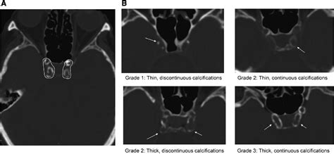 Table 1 From Intracranial Carotid Calcification On Cranial Computed Tomography Semantic Scholar