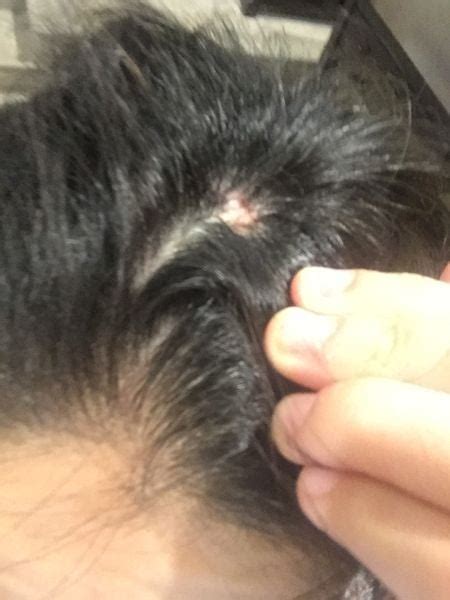 Reoccuring Bleeding Scalp Sores R Skincare Addiction