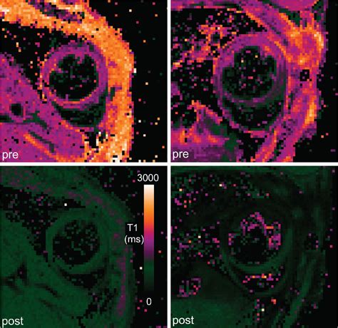 figure 1 from advanced methods for quantification of infarct size in
