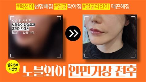 안면거상술효과 턱라인도 선명하게 드러납니다 ★더보기란 필독★ Youtube
