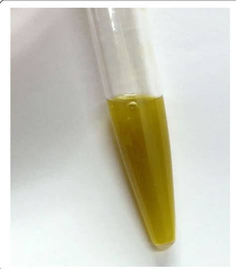 Diagnostic Paracentesis Demonstrated Ascites With A Dark Yellow Green