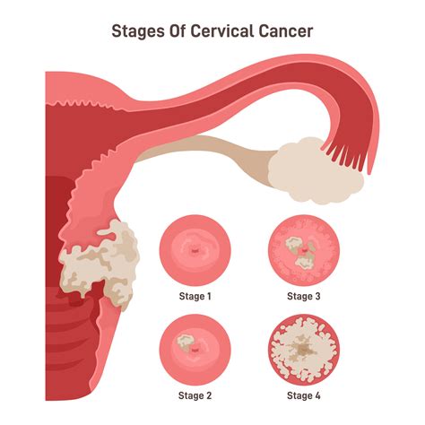 Cervical Cancer Malignant Neoplasm Arising From Cancer Cells 46422651 Vector Art At Vecteezy