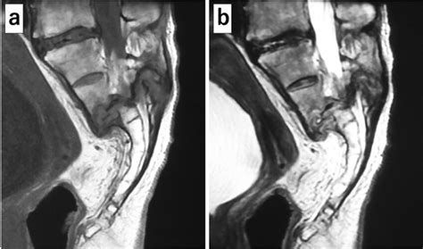 Preoperative Mri A T1 Weighted Sagittal View B T2 Weighted Sagittal