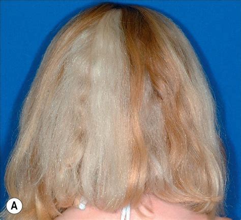 Disorders Of Hair And Nails Clinical Tree