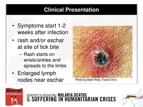 Ppt Ticks As Vectors And African Tick Bite Fever Alex Heaney 3912 Powerpoint Presentation