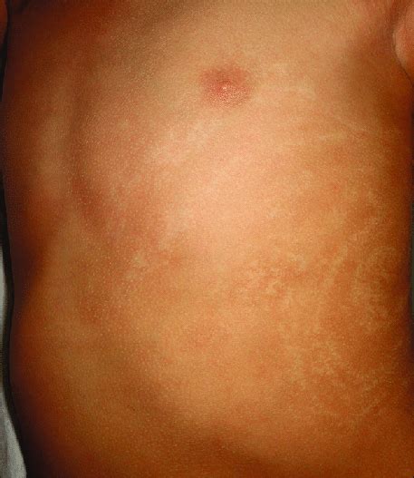 Whorled Hypopigmented Macular Areas Over Left Side Of Trunk Along The Download Scientific