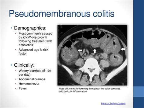 Ppt Overview And Ct Imaging Examples Of Common Colon Pathologies Powerpoint Presentation Id