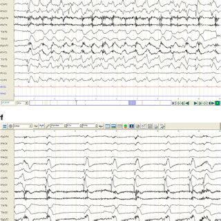 PDF Which EEG Patterns In Coma Are Nonconvulsive Status Epilepticus