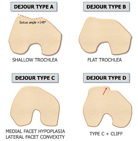 Dejour Classification Of Trochlear Dysplasia On Axial View [7] Type A