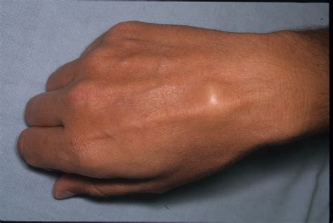 Injured Wrist Playing Soccer Now Boney Lump On Hand DiagnoseMe