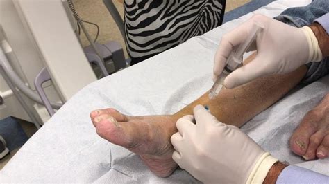 Intra Articular Injection Of The Ankle Under Fluoroscopic Guidance Youtube