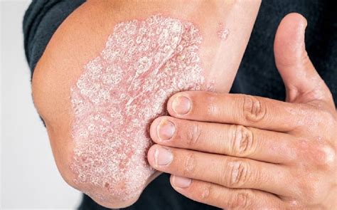 Psoriasis Qué Es Cómo Se Trata Y Por Qué Se Celebra El 29 De Octubre