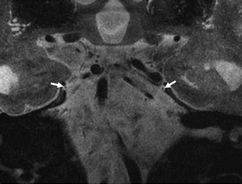 Trochlear Nerve Mri
