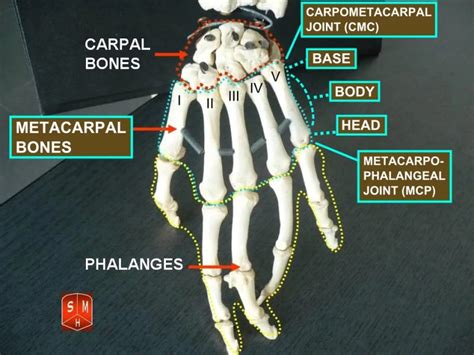 Third Metacarpal Shaft Fracture Rxharun
