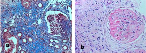 Focal Segmental Glomerulosclerosis Fsgs A Collagenous Sclerosis Download Scientific Diagram