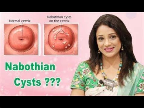Nabothian Cyst Symptoms Nabothian Cyst Dr Himani