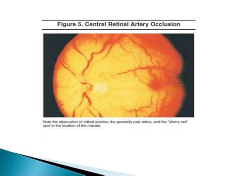 Approach To Monocular Blindness