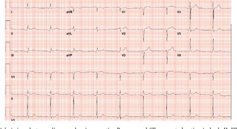 Atrial Repolarization Wave