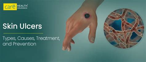 Know Complete Guidance About Skin Ulcers— Causes Diagnosis And Treatment