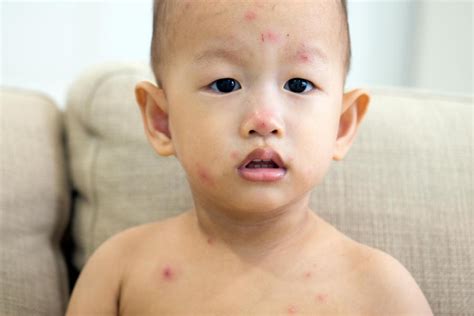 Chickenpox Nidirect