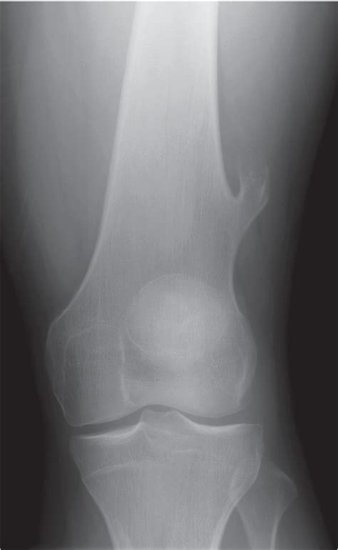 Tumor On Femur Bone Adult