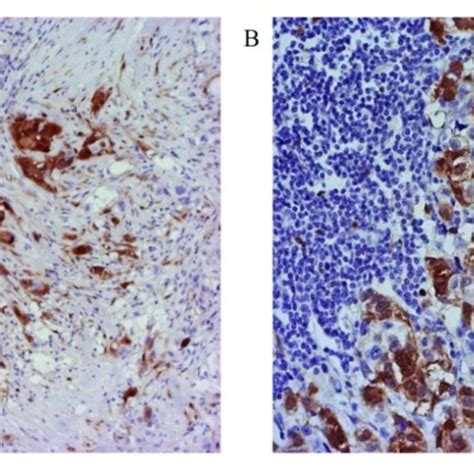 A P16 Overexpression In Stromal Fibroblasts Original Magnification