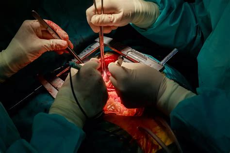 7 Key Facts About Aortic Rupture Surgery And Recovery Time