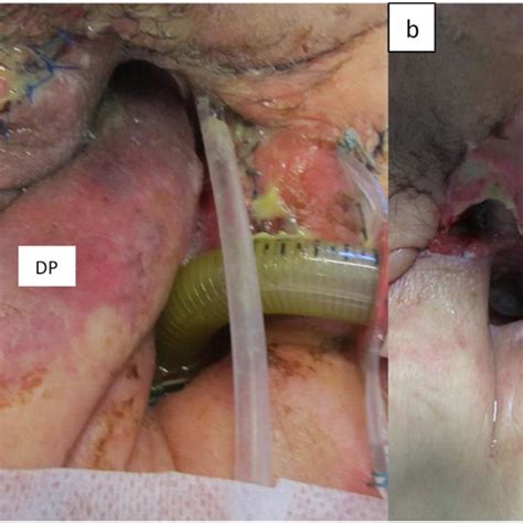 Tumorresection With Laryngectomy Partial Pharyngectomy And Bilateral
