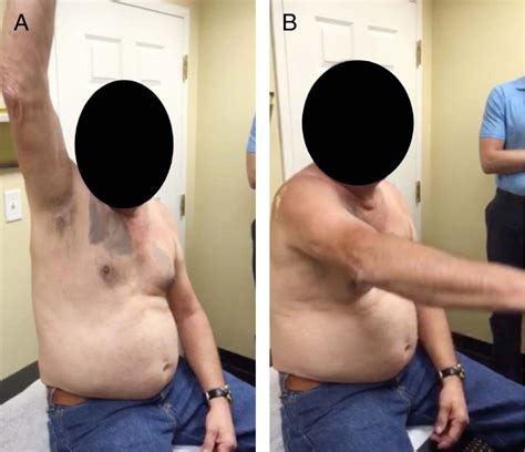 Pseudoparalysis A Systematic Review Of Term Definitions Treatment