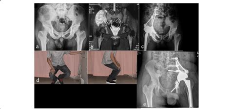 Reconstruction With The Combined Hemipelvic Endoprosthesis After Tumor Download Scientific