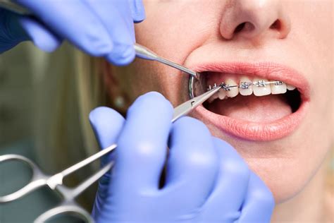 How Braces Can Transform Your Facial Profile